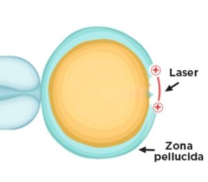 Laser Assisted Hatching at Imprimis IVF | Boost IVF Success Rates