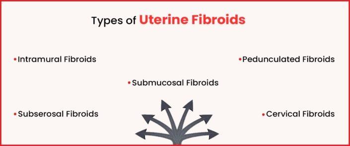 Uterine Fibroids: Causes, Symptoms & Treatment - Imprimis IVF