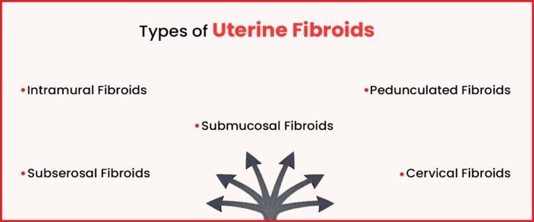 Uterine Fibroids: Causes, Symptoms & Treatment - Imprimis IVF