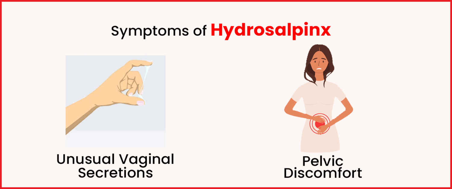Hydrosalpinx: Causes, Symptoms, Diagnosis & Treatment